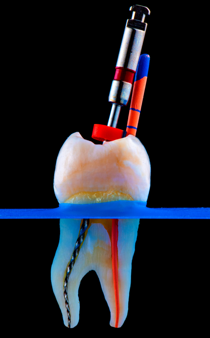 Root Canal Treatment in Dover Ridgefield Park Hackensack NJ - Aesthetic ...